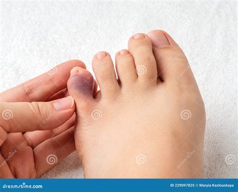 Woman Hand Touching Little Toe With Purple Bruise After Home Accident