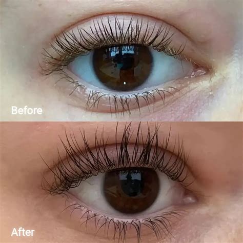 Lash Serum Side Effects Risks You Should Know Forchics