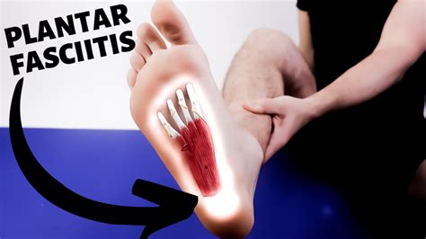 Heel Spur Surgery Recovery Time Michigan Podiatrist