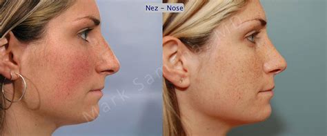Rhinoplastie Rhinoplasty Avant Après Photos Before and After