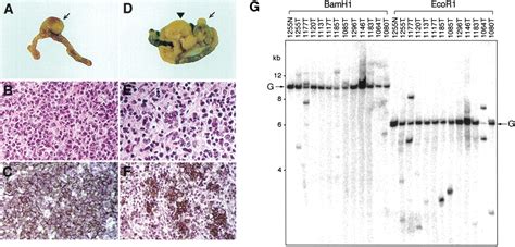 ~liver Is Enlarged And Diffusely Echogenic Diffusely Heterogeneous