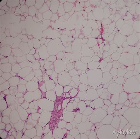 Lipoma Benign Growth Of Fatty Tissue Benign Neoplasm Adipocytes