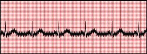 What Is An EKG Artifact Nursing Babe Assistance Allnurses
