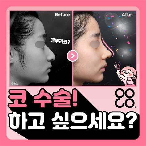 Eng Sub 코 성형 하고 싶나요 그럼 이 정도는 알아야죠🧐 Do You Want To Undergo Rhinoplasty If So You Should