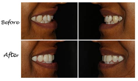 How To Fix The Gaps Between Your Teeth Silver Oaks Dental Clinic