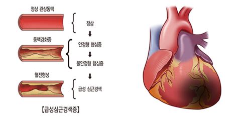 201701 관상동맥질환 협심증 심근경색 웹진 일반인정보 심장병원 서울아산병원