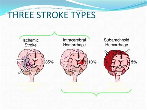 Guidelines For Management Of Acute Stroke