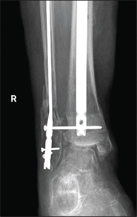 Postoperative Syndesmotic Widening Following Ankle Fracture Fixation A