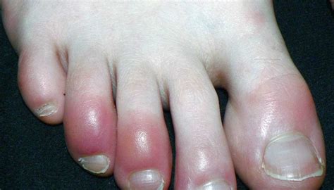 Big Toe Inflammation