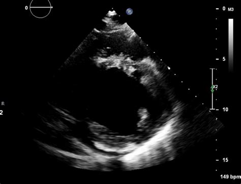 Sounds Like Ecmo Trouble Intensive