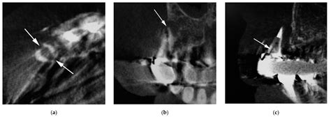 Diagnosis Of Vertical Root Fractures In Endodontically Treated Teeth By