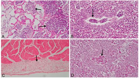 A Fibrinous Bronchopneumonia In The Lungs Neutrophil Granulocytes And