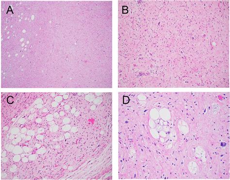 Well Differentiated Spindle Cell Liposarcoma Of The Larynx A Rare Case