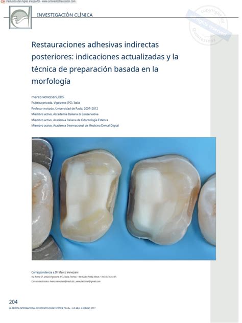 Posterior Indirect Adhesive Restorations Updated Indications And The