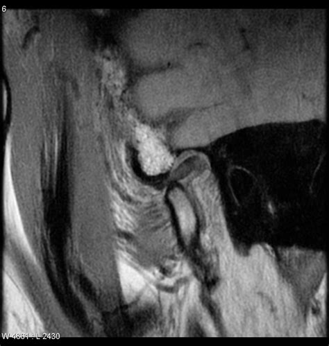 On Radiology Mri Of Temporomandibular Joint Effusion