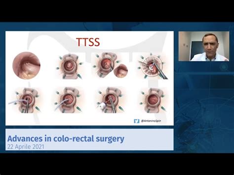 Laparoscopic Restaurative Proctocolectomy With J Reservoir Functional Results General Surgery