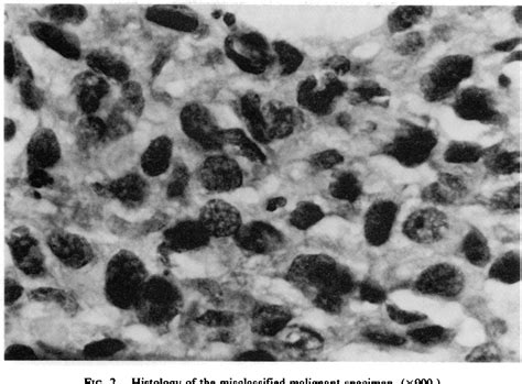 Figure From Multisurface Method Of Pattern Separation For Medical Diagnosis Applied To Breast