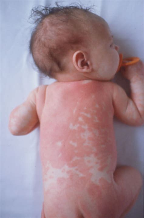 Erythrodermia Leiner Doccheck