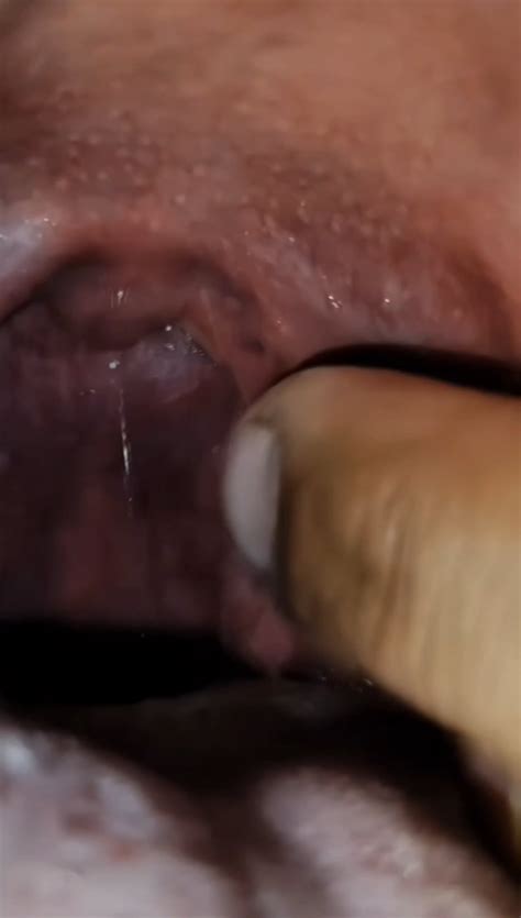 ️is It Normal For Tonsil Stones To Talk To Me Via Telepathy 🪨💭 R Tonsilstones