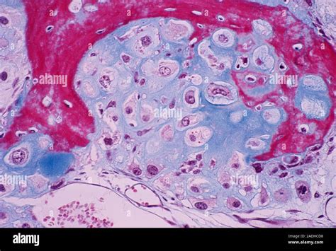 Bone Cancer Light Micrograph Of A Section Through A Chondrosarcoma A