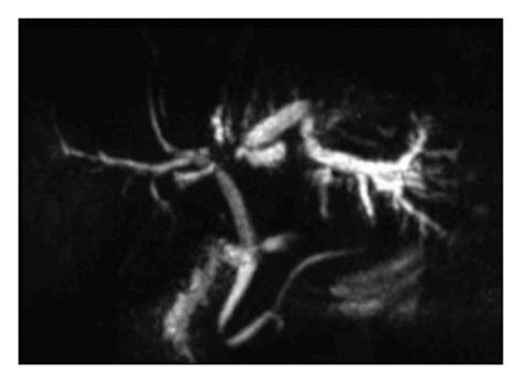 Perihilar Cholangiocarcinoma A An Mrcp Image As A Focal Stricture