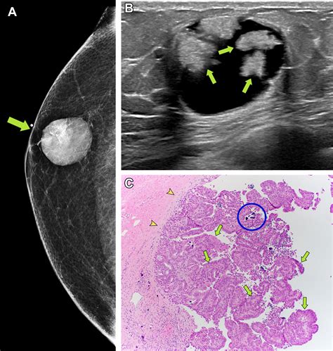 Papillary Neoplasms Of The Breast Who Classification Multimodality