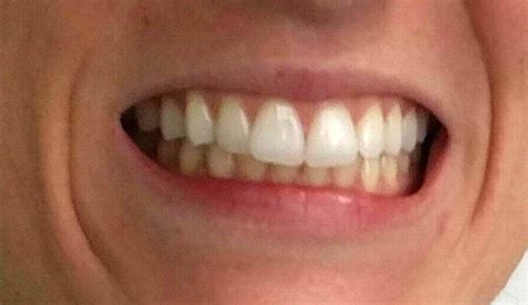 Bruxismo archivos Clínica Dental Dr Fuset