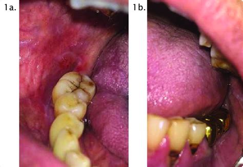 A Initial Presentation Diffuse Erythematous Area With Interspersed