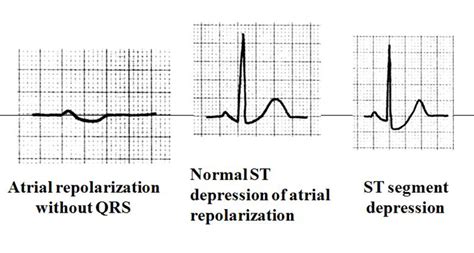 Dr Smiths Ecg Blog Atrial Repolarization Wave Mimicking St Depression