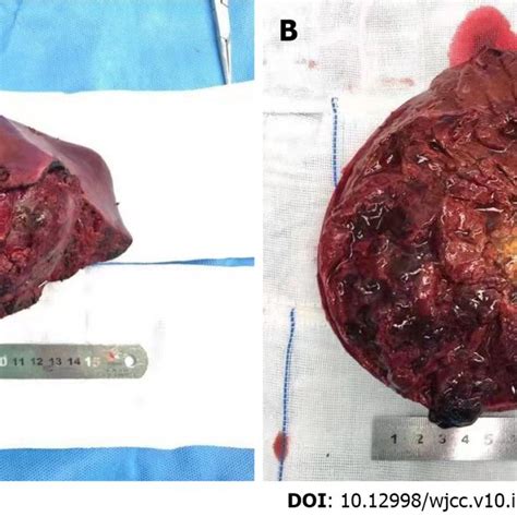These Are Conducive To Complete Resection Reducing The Rate Of Download Scientific Diagram