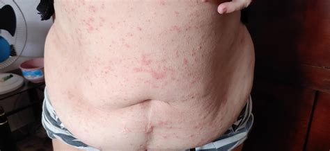 Help Me Identify This Skin Rash Please Rdermatologyquestions