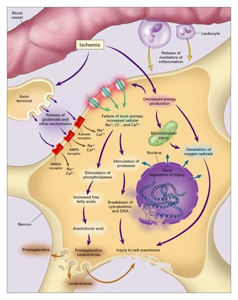 Acute Ischemic Stroke
