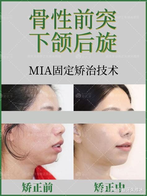 南京牙齿矫正：利用骨钉形成支抗，精准控制内收，逆旋出完美下巴 知乎