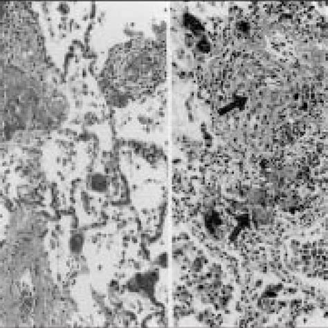 Left Small Pulmonary Arteries Showing Intimal Fibrosis Prominent Download Scientific Diagram