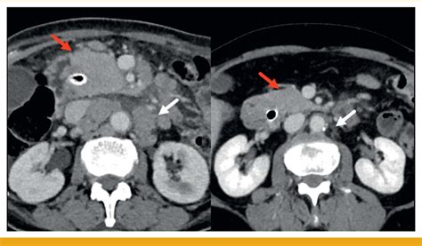 Computed Tomography Scans Of Local Tumor Response Left November 2020