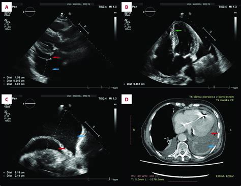 Pleural Effusion Ple The Parasternal Long Axis View S