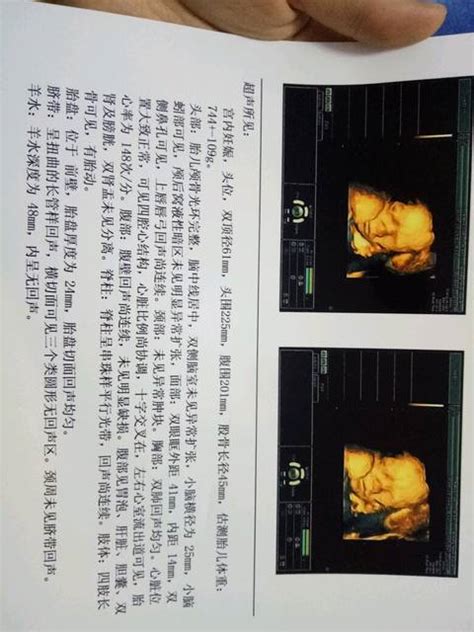 6个月四维彩超看男女 6个月四维彩超图片女宝宝照片 随意云
