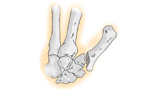 Metacarpal Neck Fracture