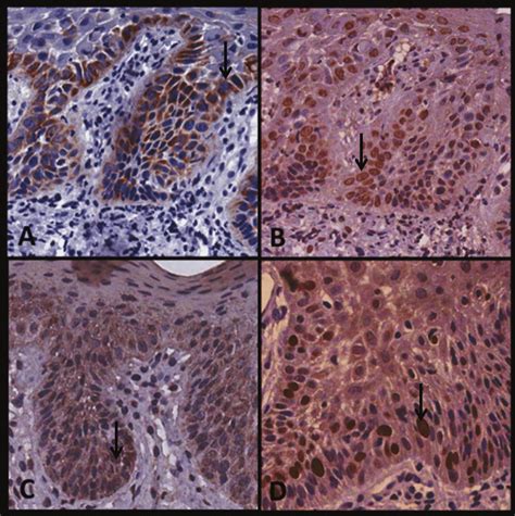 Expression Of P16 Bub3 Sox4 And Ki67 In Od Case No 29 A P16