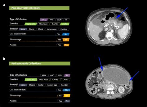 A Proposed Template And Axial Cect Image Of An Acute Peripancreatic