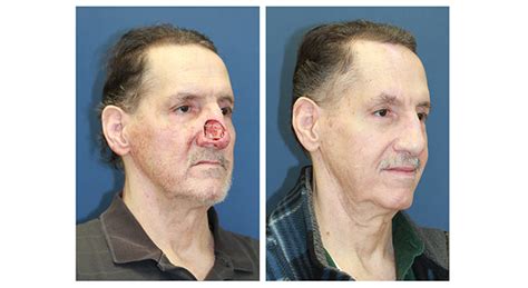 Facial Reconstruction Before And After Gallery Mount Sinai New York
