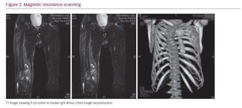 Tumour Induced Osteomalacia Secondary To A Sarcoma Touchendocrinology
