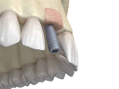 Bone Density For Dental Implants What To Know