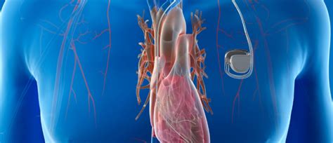 Insertion Of A Pacemaker Or Defibrillator Device Monash Heart Private