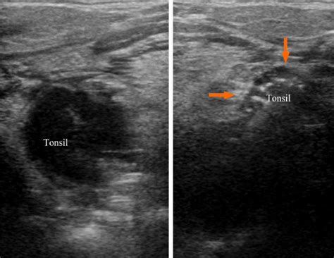 Ultrasound Features Of Primary Non Hodgkins Lymphoma Of The Palatine