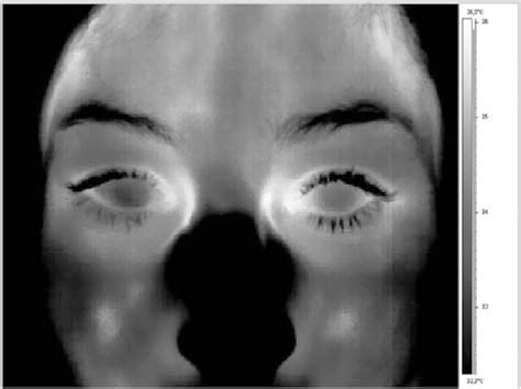 Subject 2 Bilateral Maxillary Sinusitis Contrasted Thermogram