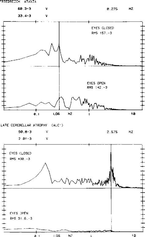 Figure 4 From Quantification Of Postural Sway In Normals And Patients