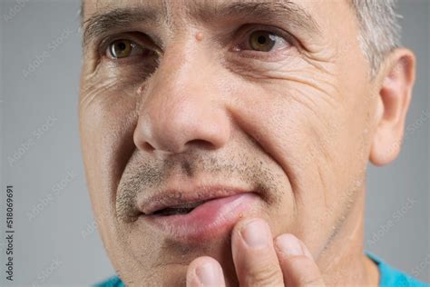 Allergic Reaction To A Bee Sting An Unshaven Man Was Stung By A Bee