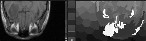 Bug Or Feature Slic Superpixel Segmentation Algorithms Itk