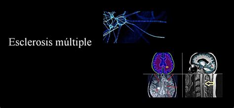 Esclerosis Múltiple Síntomas Causas Y Tratamientos Arthros Vigo